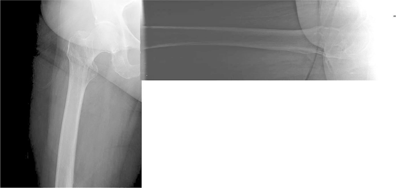 JBJS: Atraumatic Failure of the DePuy Synthes Trochanteric Fixation ...