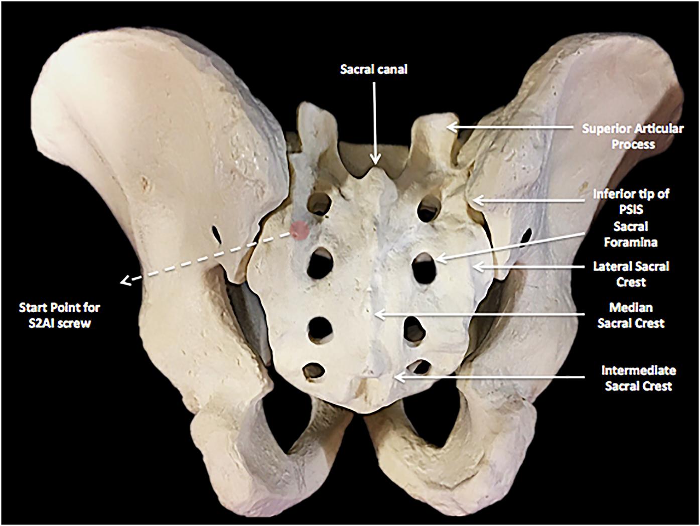 JBJS: The Free-Hand Technique for S2-Alar-Iliac Screw Placement