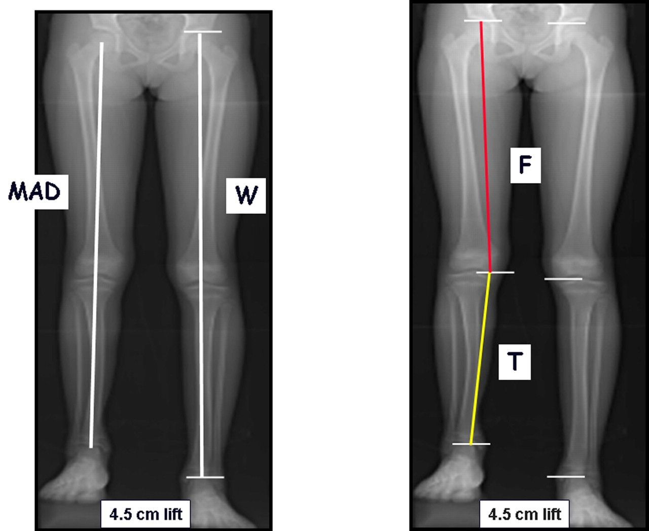 JBJS: Computed Radiographic Measurement of Limb-Length Discrepancy